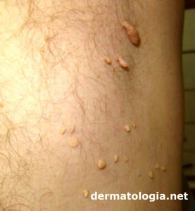 Acrocórdon, fibroma mole - Dermatologia.netDermatologia.net