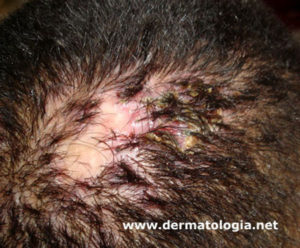 Foliculite - Dermatologia.netDermatologia.net
