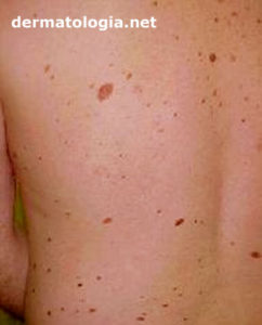 Nevo melanocítico ou nevo pigmentado - Dermatologia.netDermatologia.net