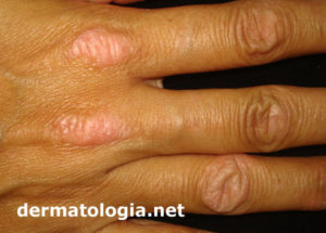 Psoríase - Dermatologia.netDermatologia.net