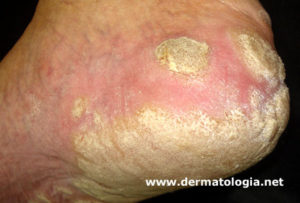 Psoríase - Dermatologia.netDermatologia.net